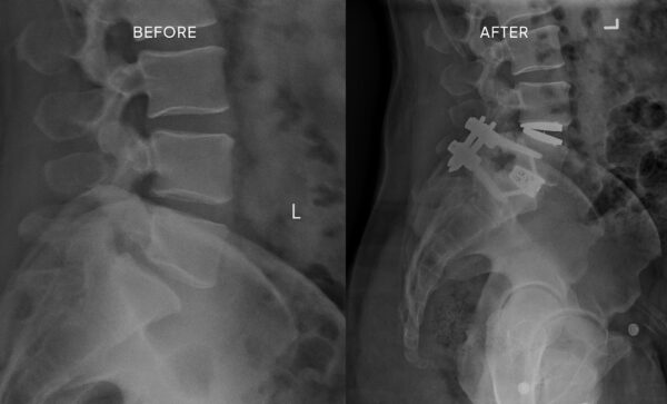 Artificial Disc Replacement vs. Fusion: Which is Right for You? | Dr ...